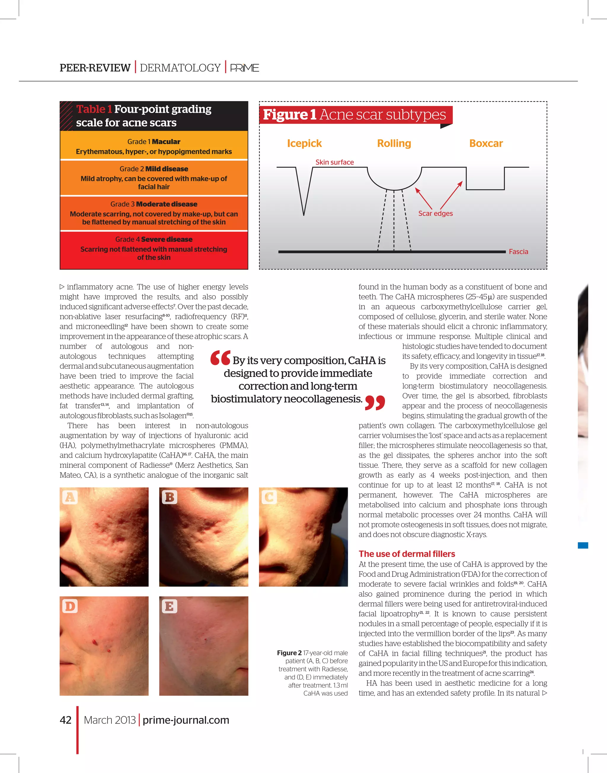 Radiesse study on atrophic acne scarring | PDF