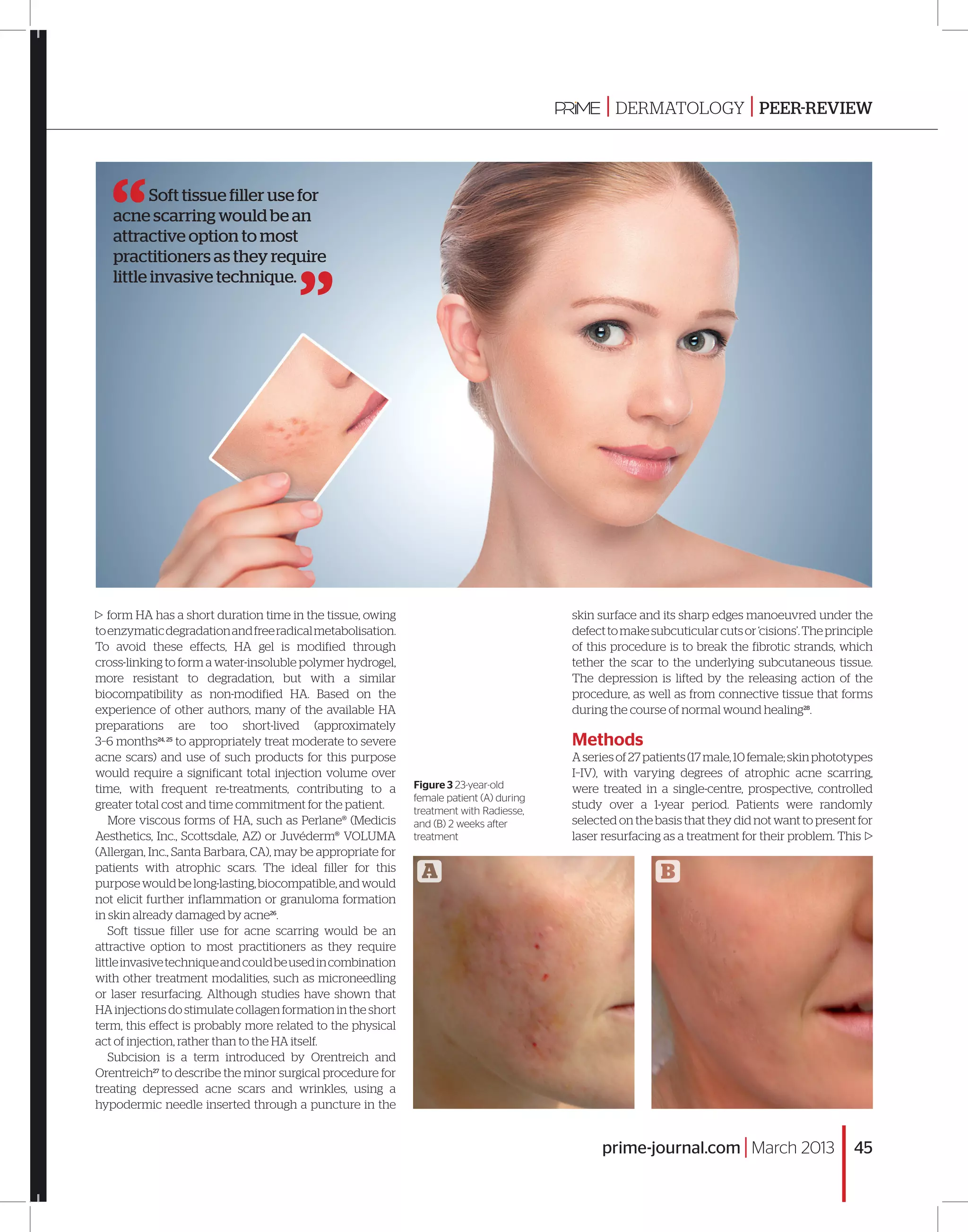 Radiesse study on atrophic acne scarring | PDF