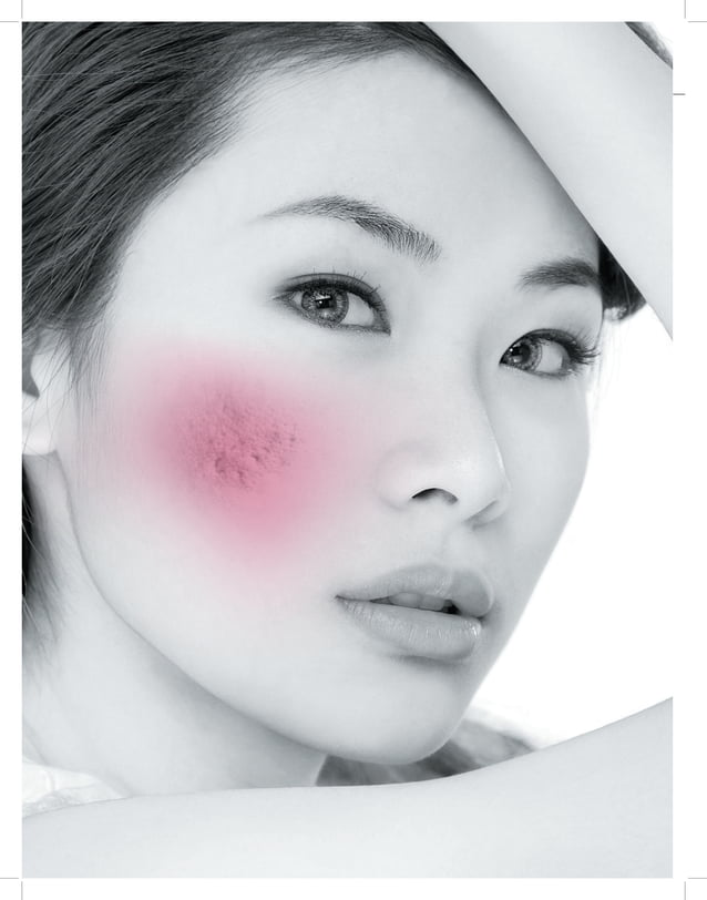 Radiesse study on atrophic acne scarring | PDF