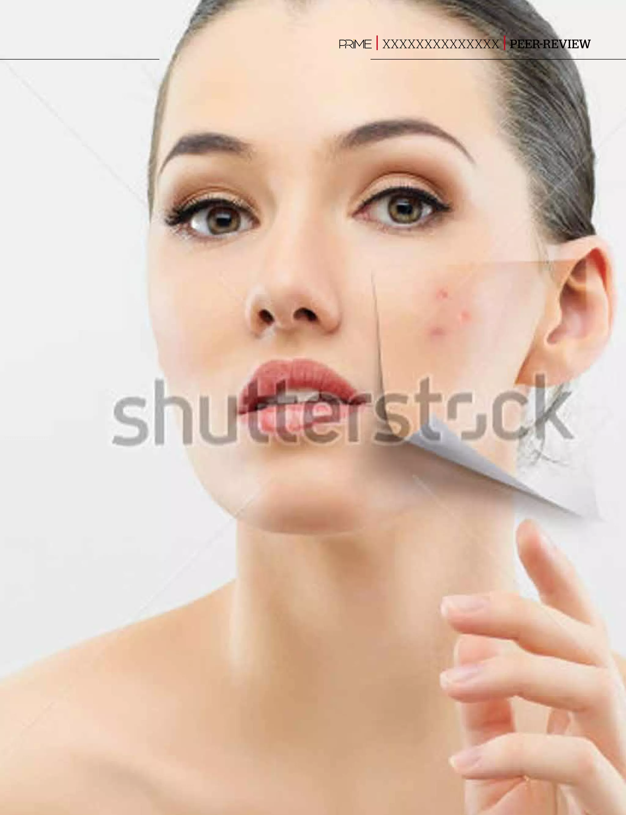 Atrophic Acne Scarring and Dermal Filling | PDF