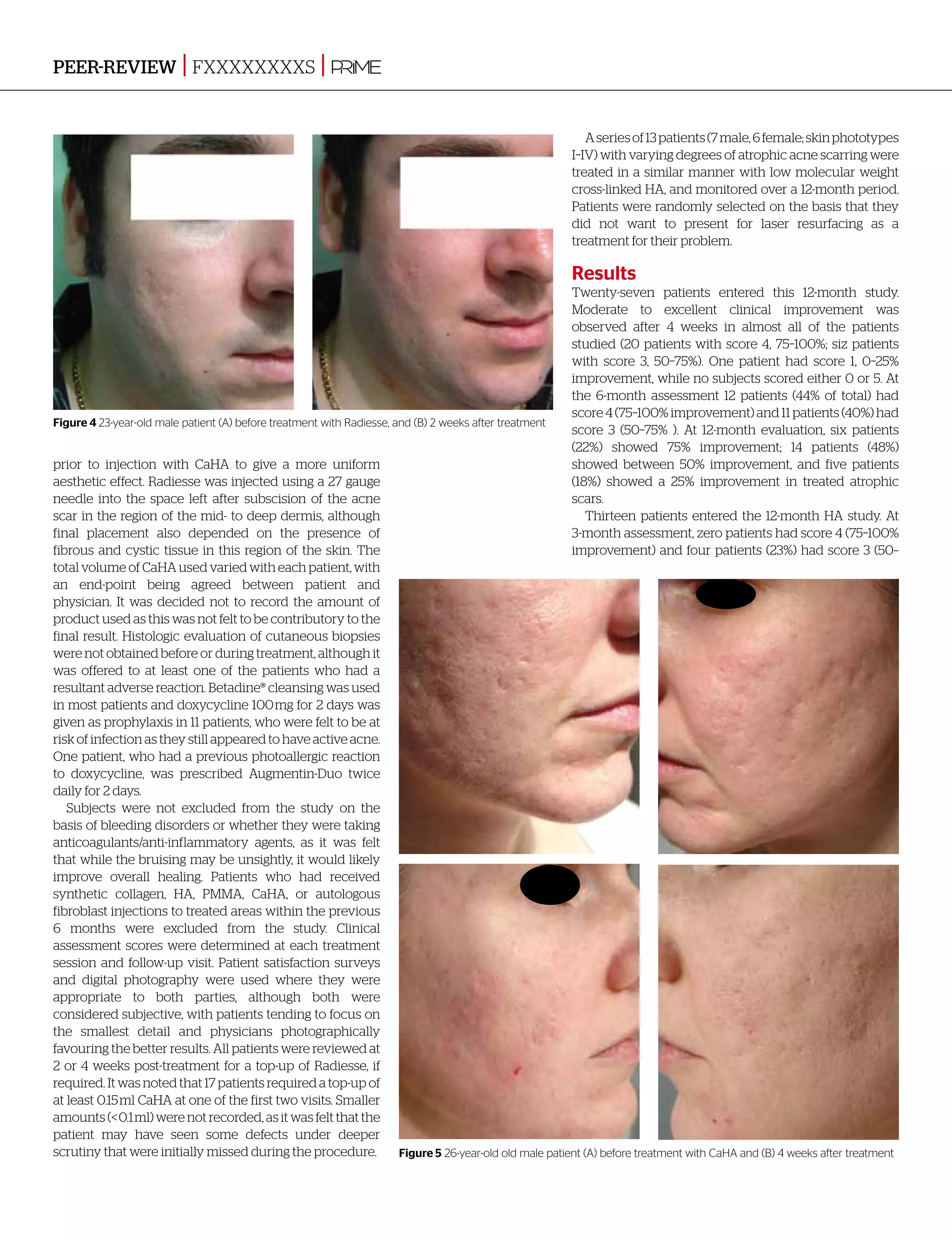 Atrophic Acne Scarring and Dermal Filling | PDF