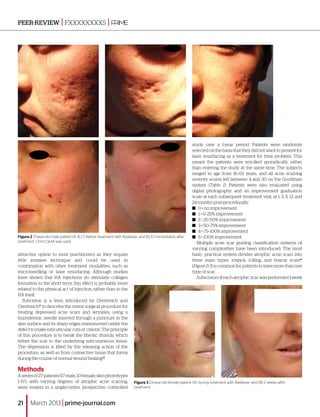 Atrophic Acne Scarring and Dermal Filling | PDF