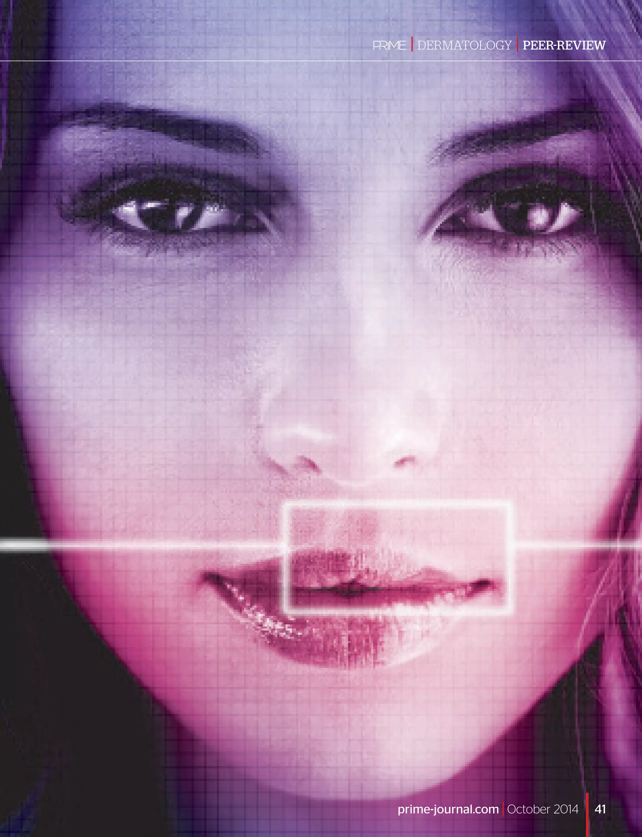 SURGICAL CORRECTION OF SEMI-PERMANENT LIP FILLER NODULES | PDF | Skin ...