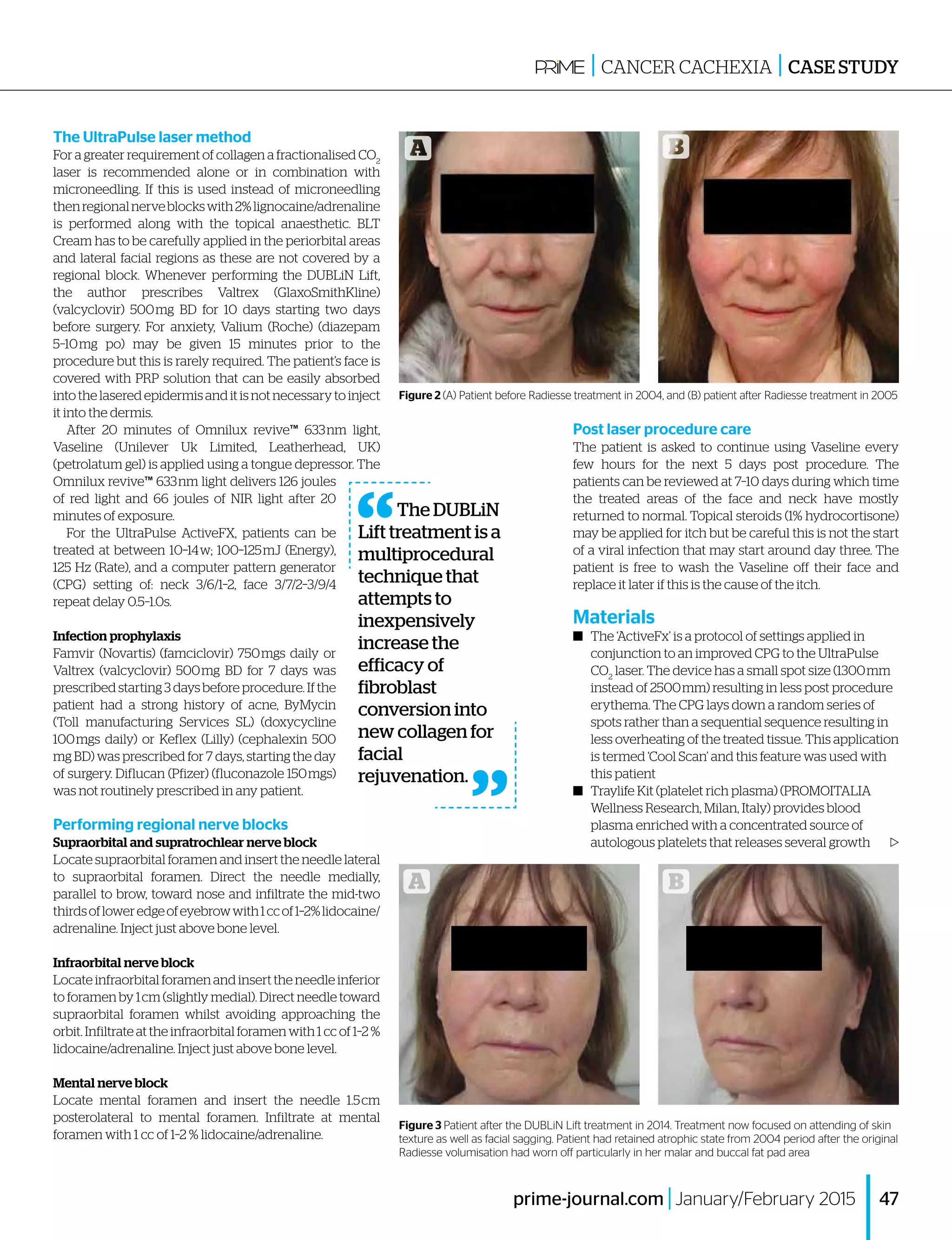 Treating face wasting secondary to cancer related cachexia | PDF