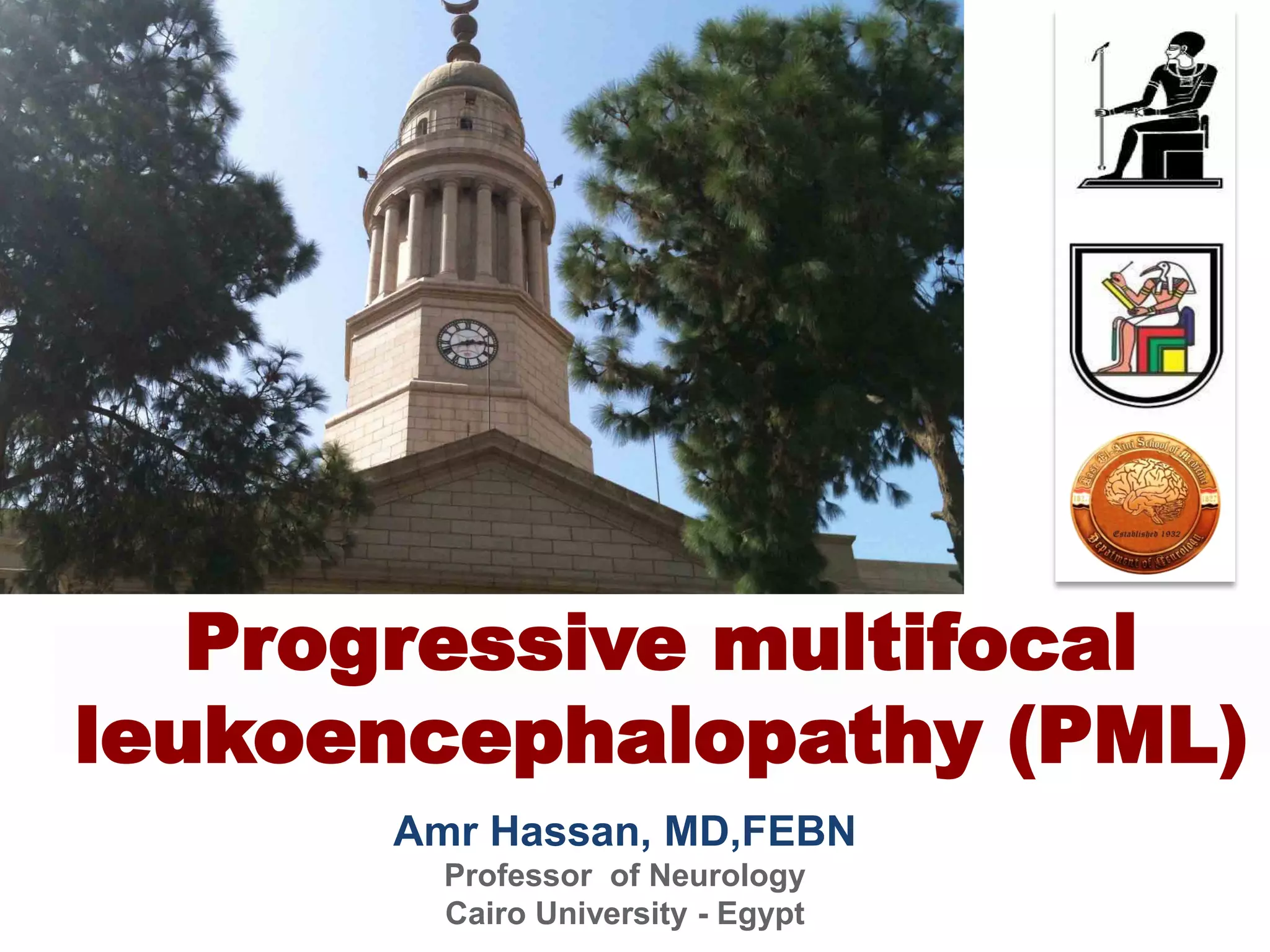 Progressive multifocal leukoencephalopathy (PML) | PDF