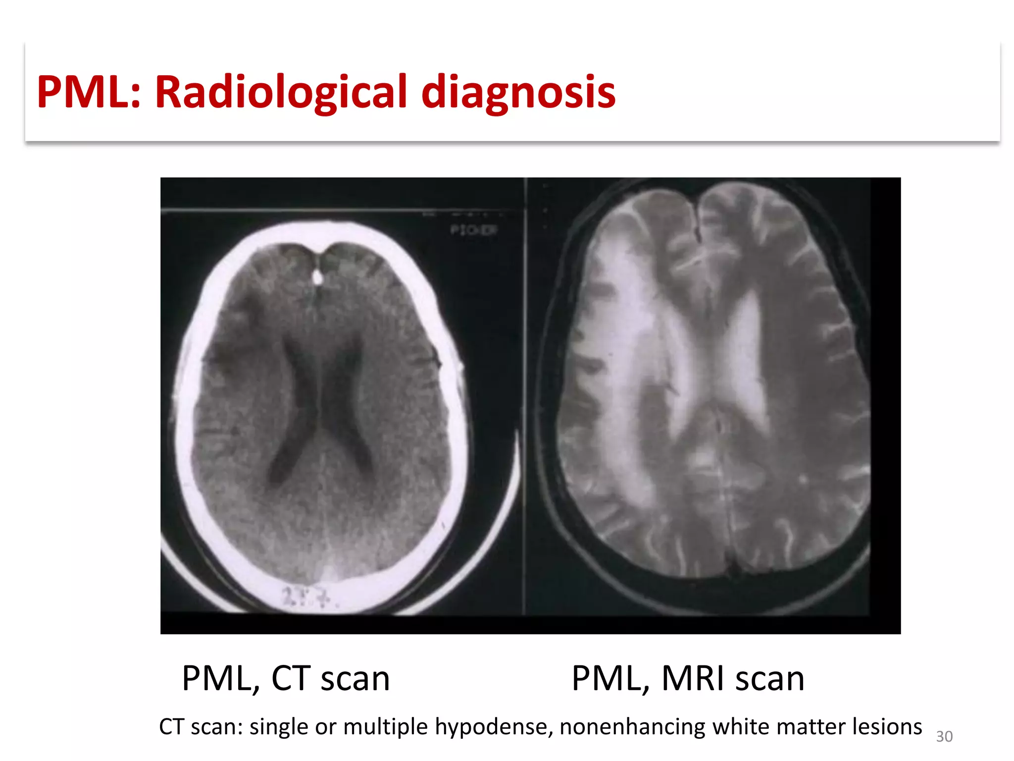 Progressive multifocal leukoencephalopathy (PML) | PDF