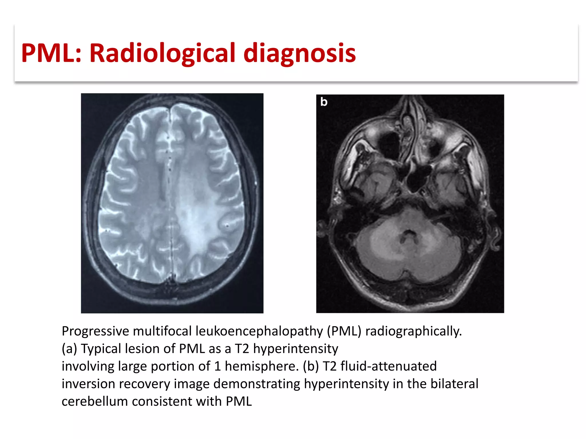 Progressive multifocal leukoencephalopathy (PML) | PDF