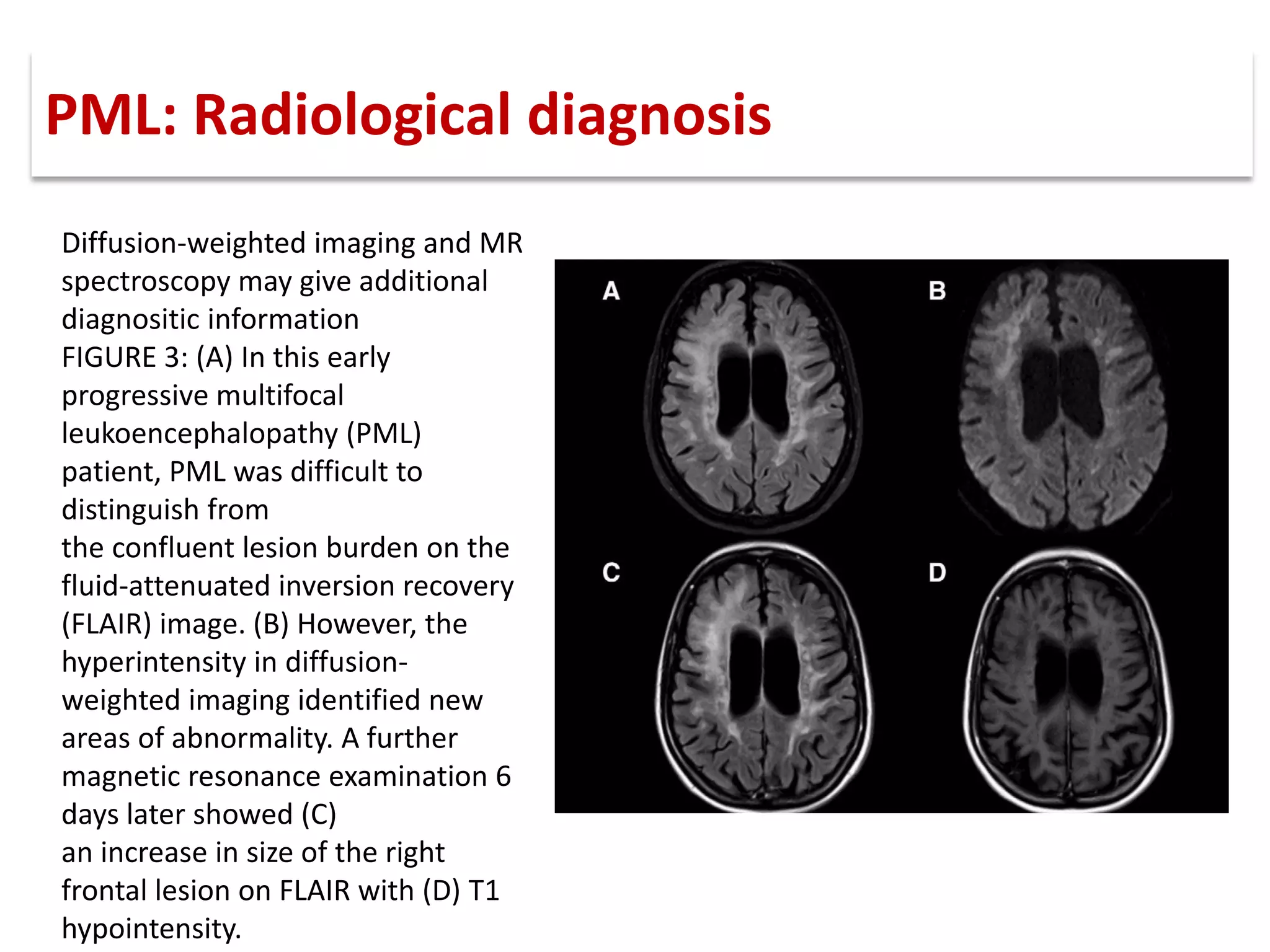 Progressive multifocal leukoencephalopathy (PML) | PDF