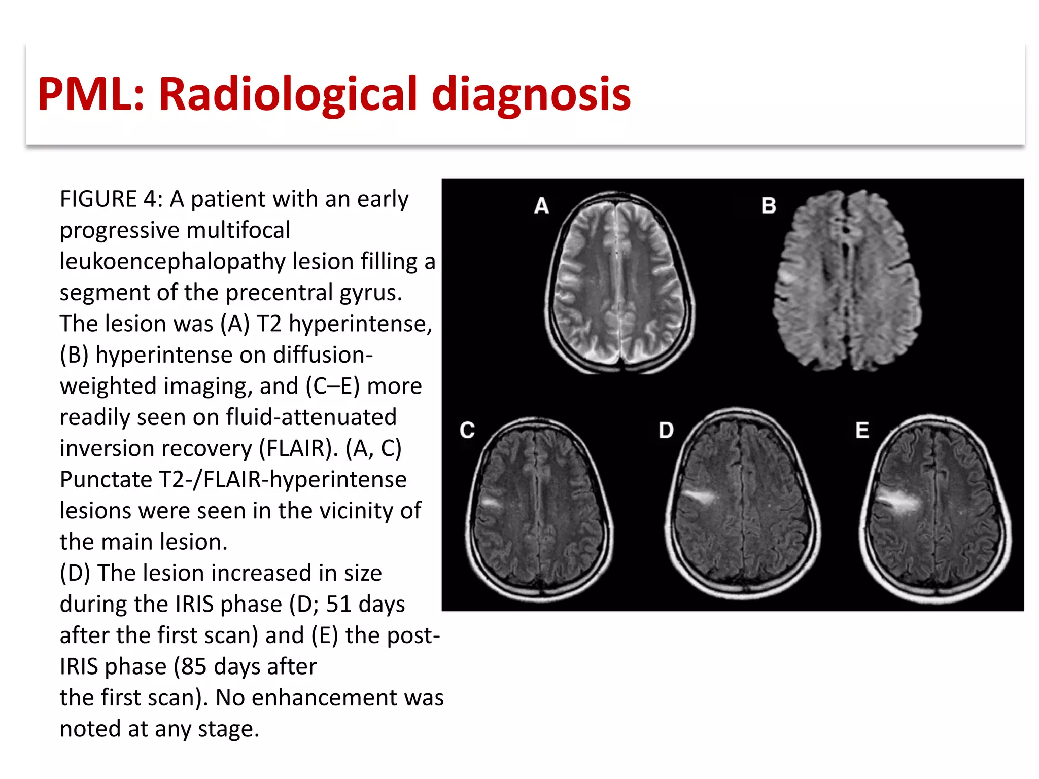 Progressive multifocal leukoencephalopathy (PML) | PDF
