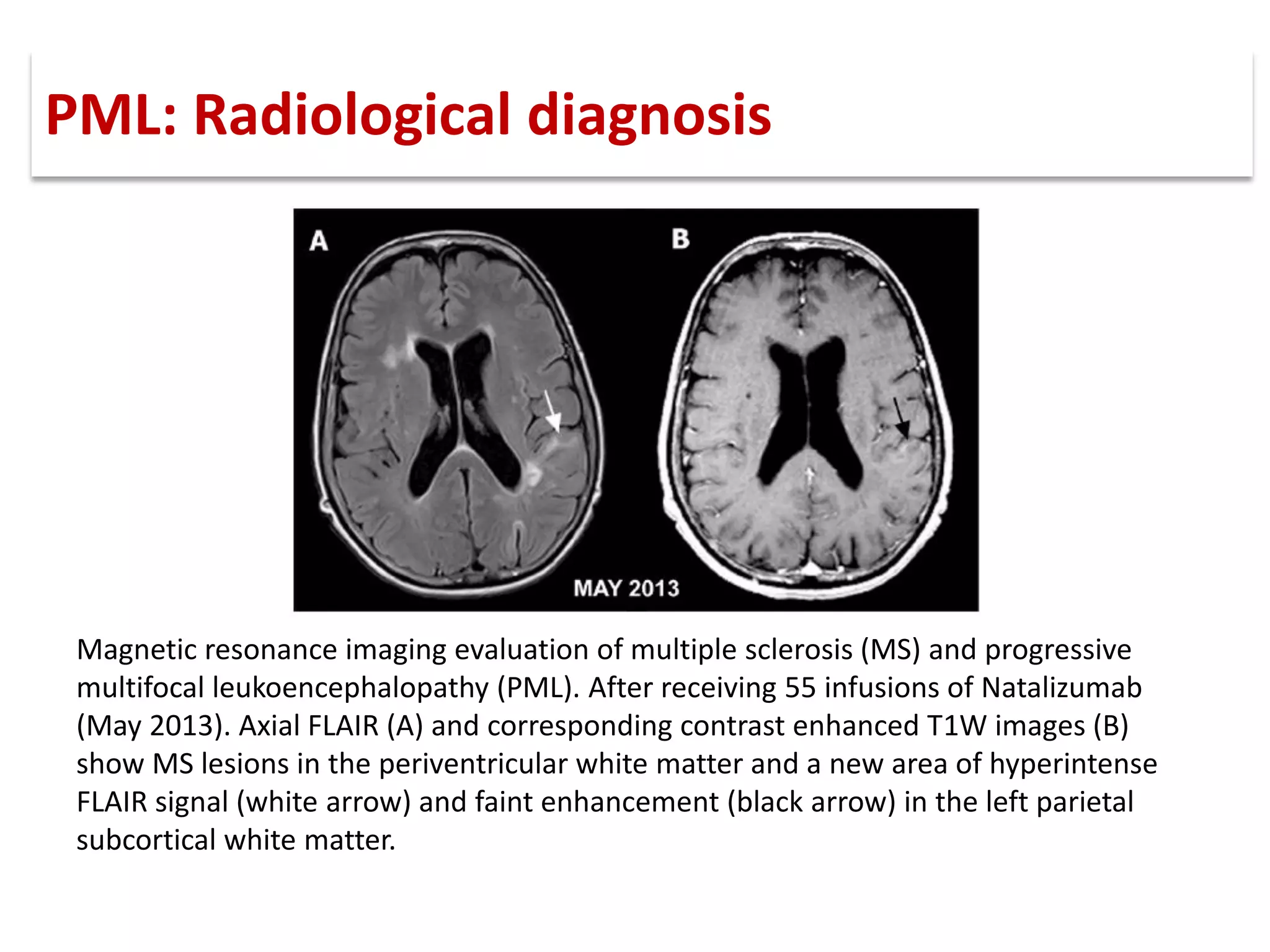 Progressive multifocal leukoencephalopathy (PML) | PDF