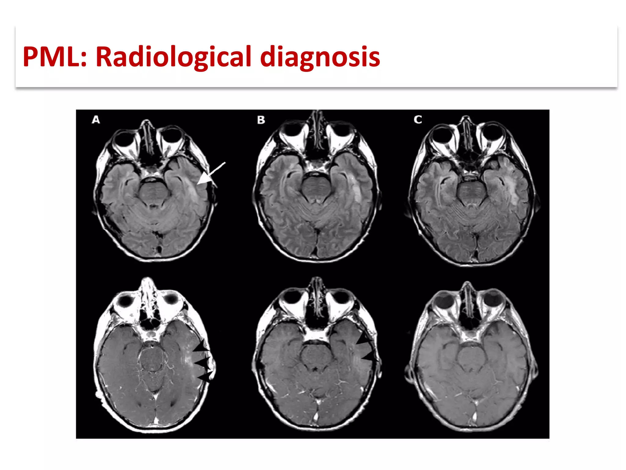 Progressive multifocal leukoencephalopathy (PML) | PDF