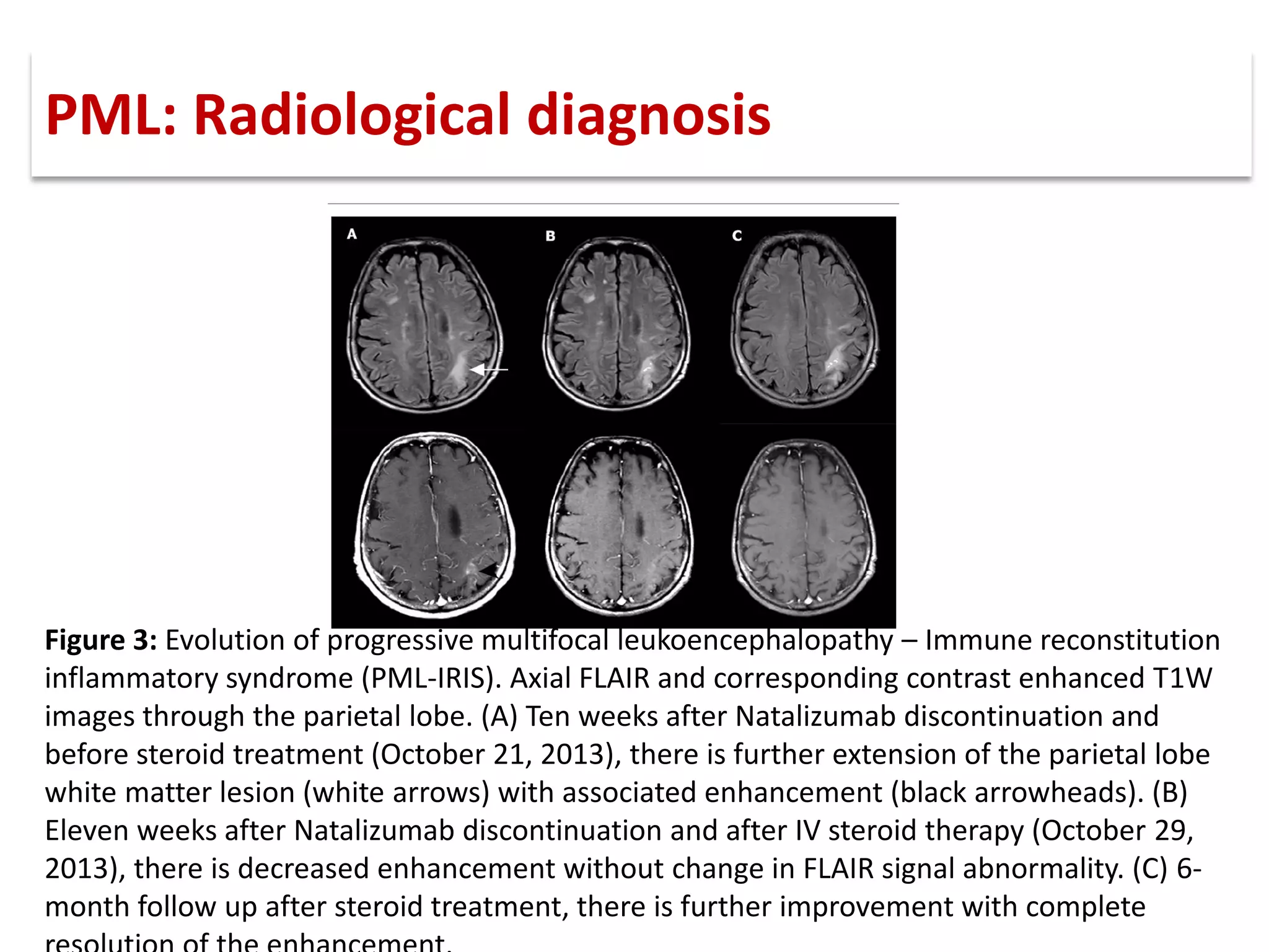 Progressive multifocal leukoencephalopathy (PML) | PDF