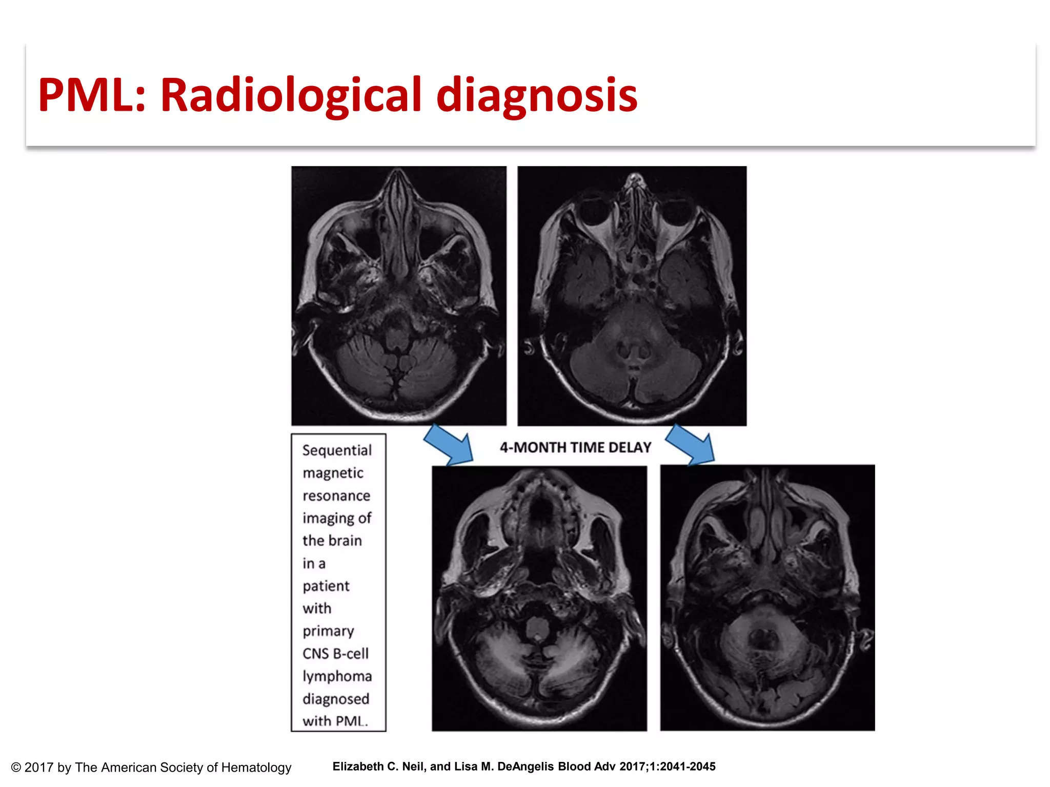 Progressive multifocal leukoencephalopathy (PML) | PDF