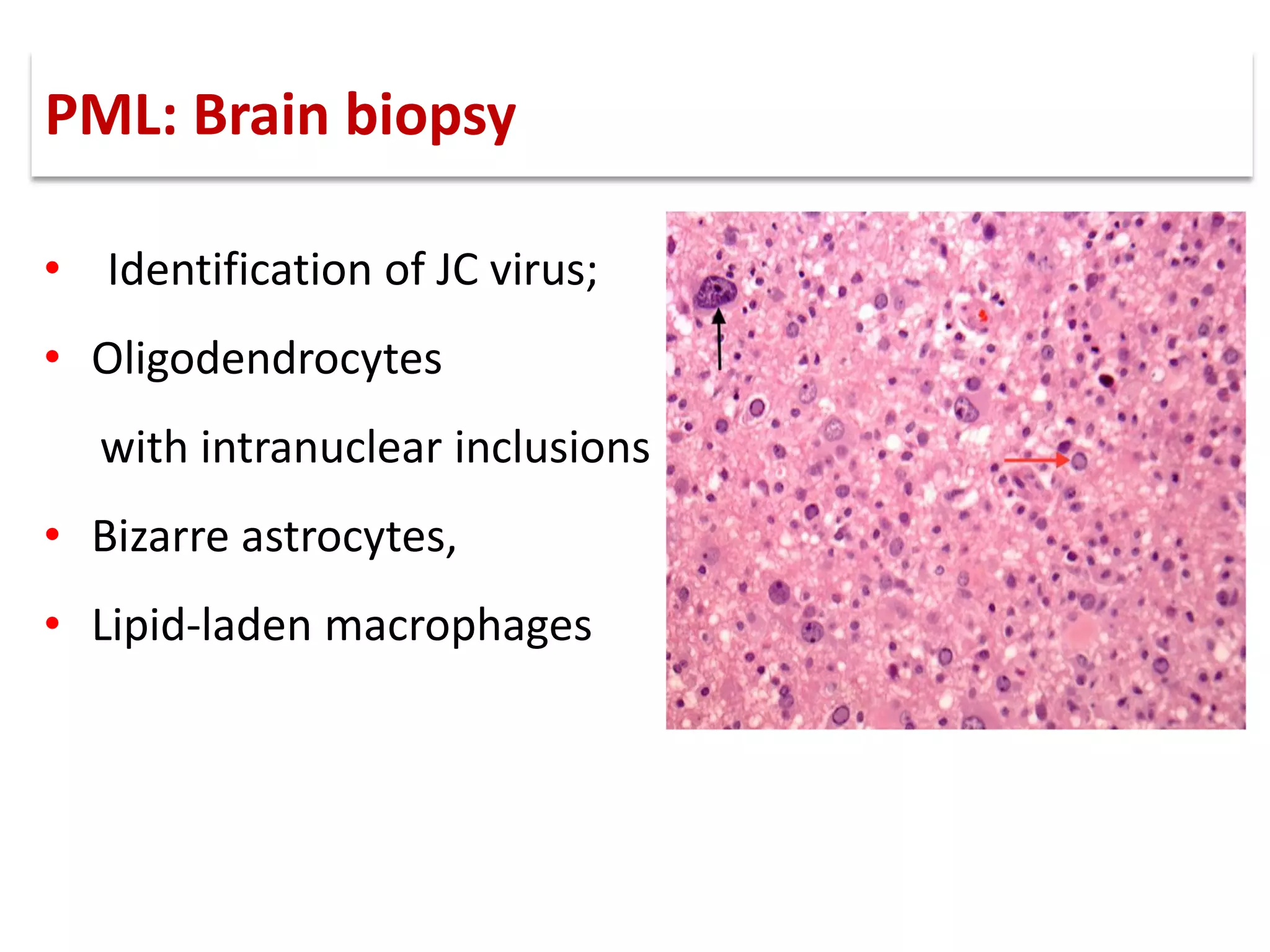 Progressive multifocal leukoencephalopathy (PML) | PDF