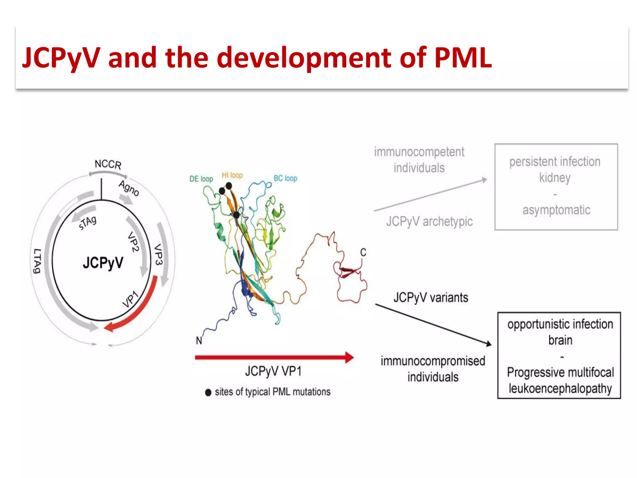 Progressive multifocal leukoencephalopathy (PML) | PDF