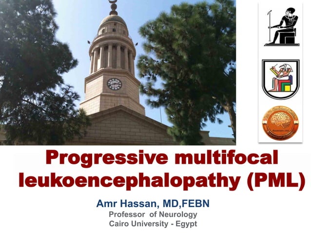 Progressive multifocal leukoencephalopathy (PML) | PDF