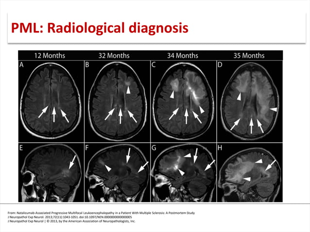 Progressive multifocal leukoencephalopathy (PML) | PDF