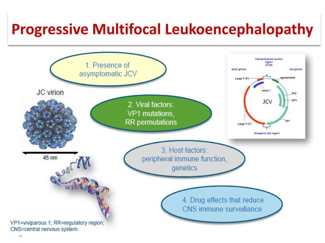 Progressive multifocal leukoencephalopathy (PML) | PDF