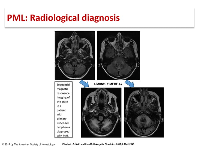 Progressive multifocal leukoencephalopathy (PML) | PDF