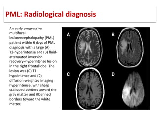 Progressive Multifocal Leukoencephalopathy Mri