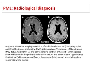 Progressive multifocal leukoencephalopathy (PML) | PPT