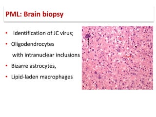Progressive Multifocal Leukoencephalopathy Histology