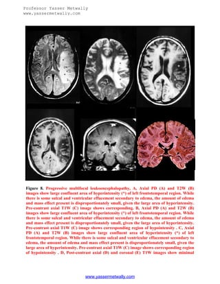Progressive multifocal leukoencephalopathy | PDF | Brain and Nervous ...
