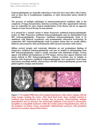 Progressive Multifocal Leukoencephalopathy Histology