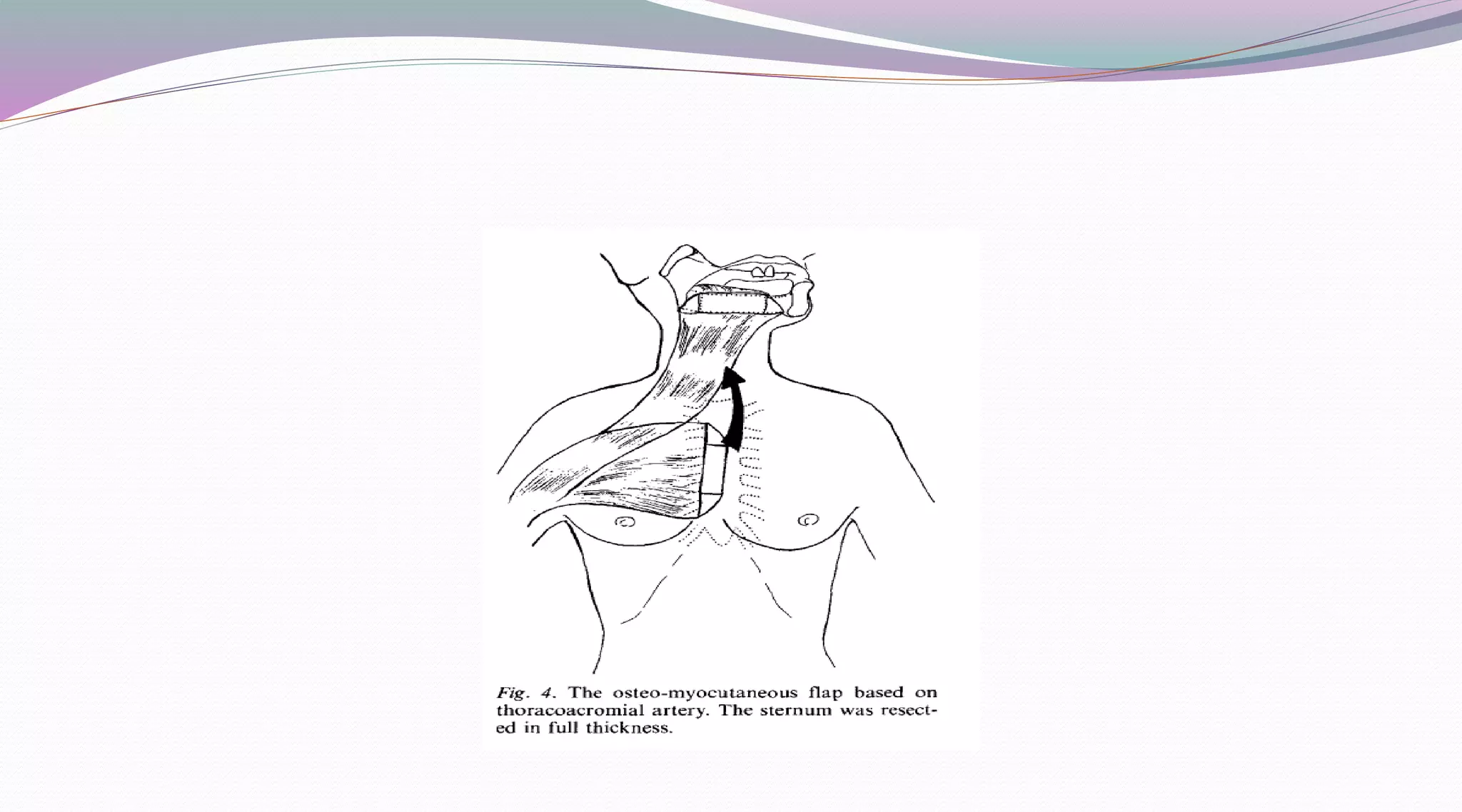 PMMC FLAP | PPTX