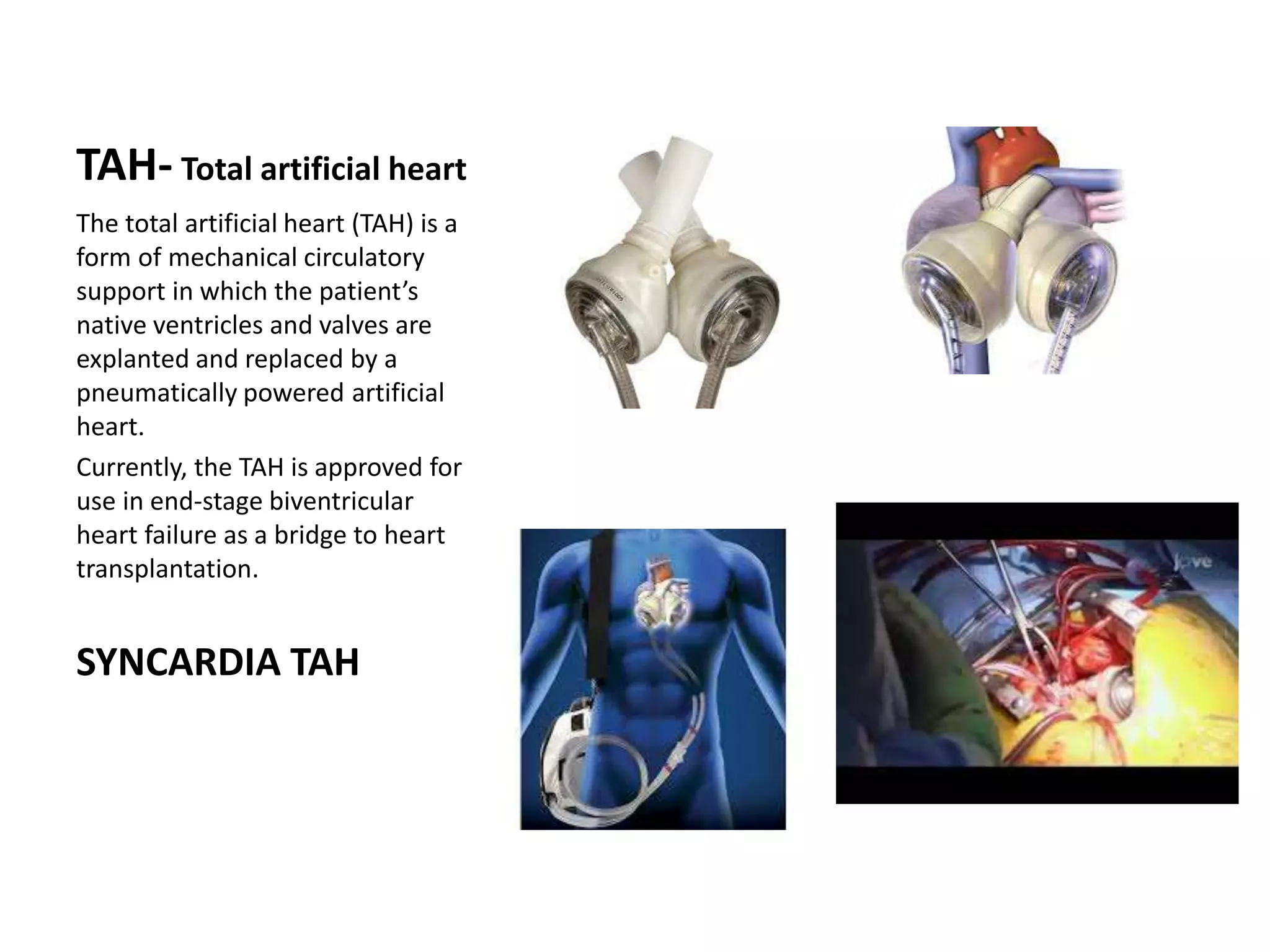 Recent Advances in Cardiothoracic Surgery | PPTX