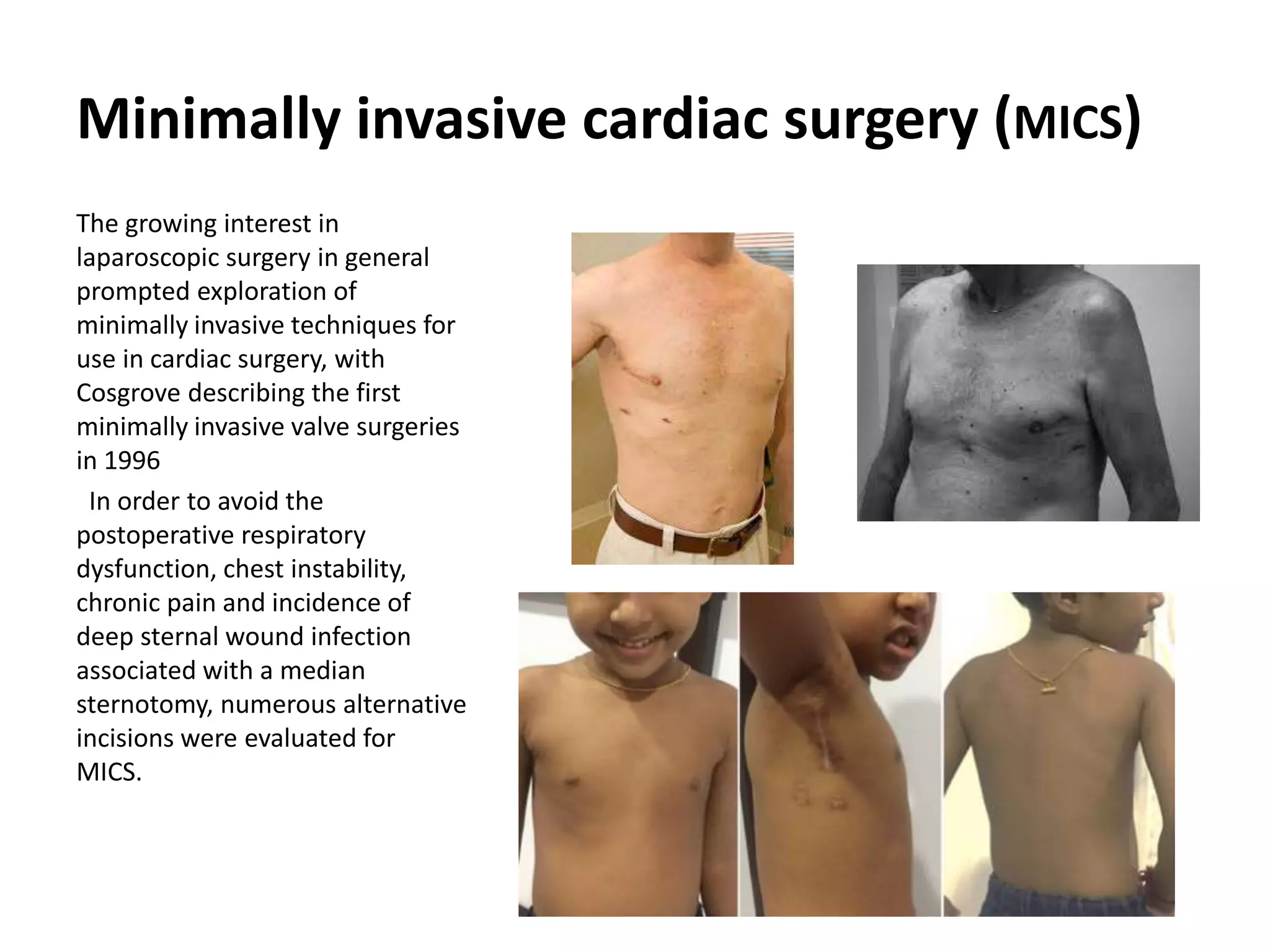 Recent Advances in Cardiothoracic Surgery | PPTX