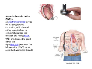 Recent Advances in Cardiothoracic Surgery | PPTX
