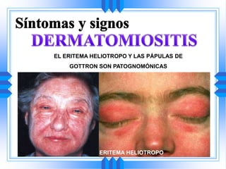 Polimiositis y dermatomiositis | PPT