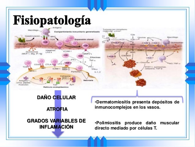 Polimiositis y dermatomiositis