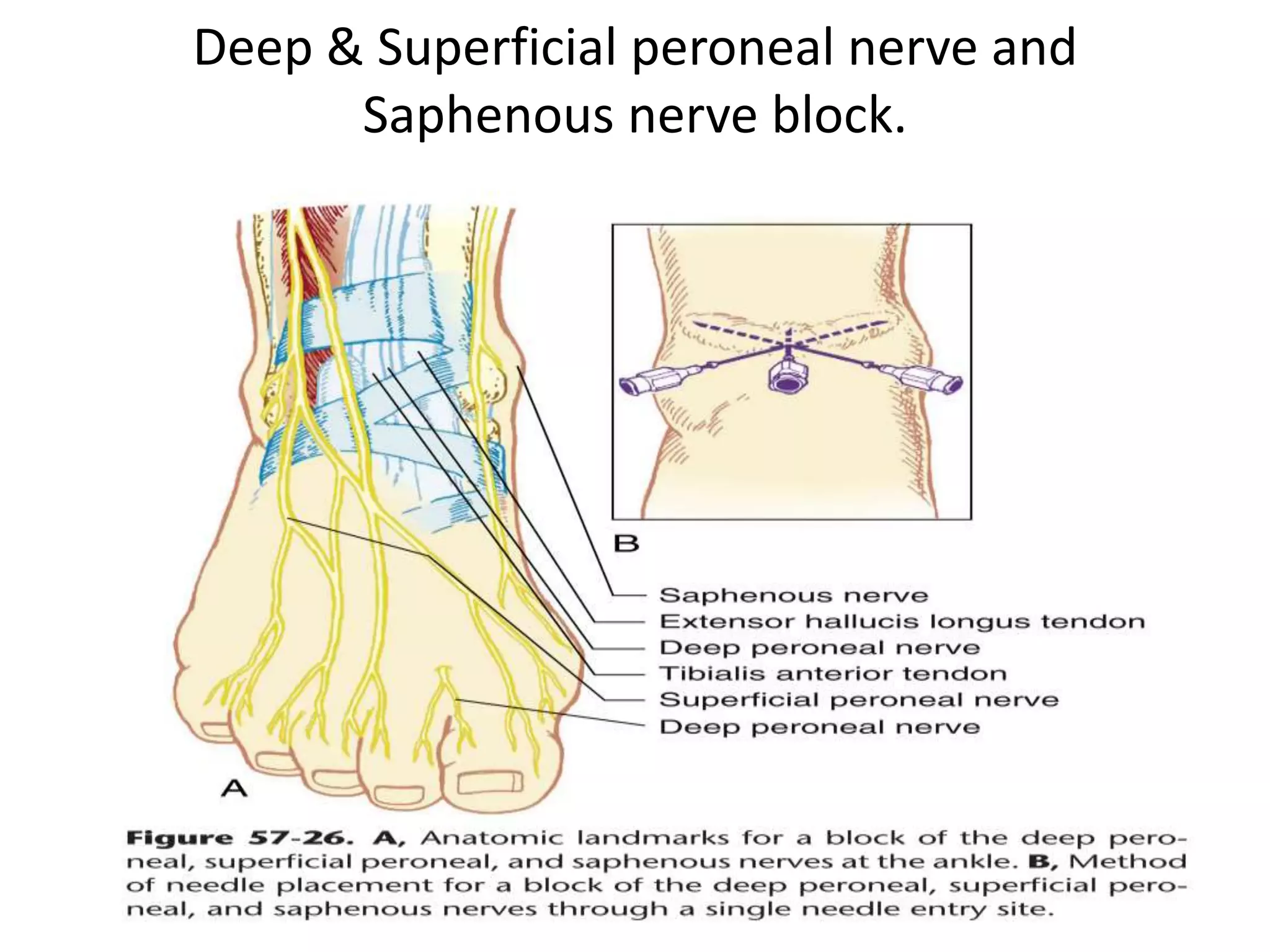 PNB of lower limb & paravertebral block | PPTX