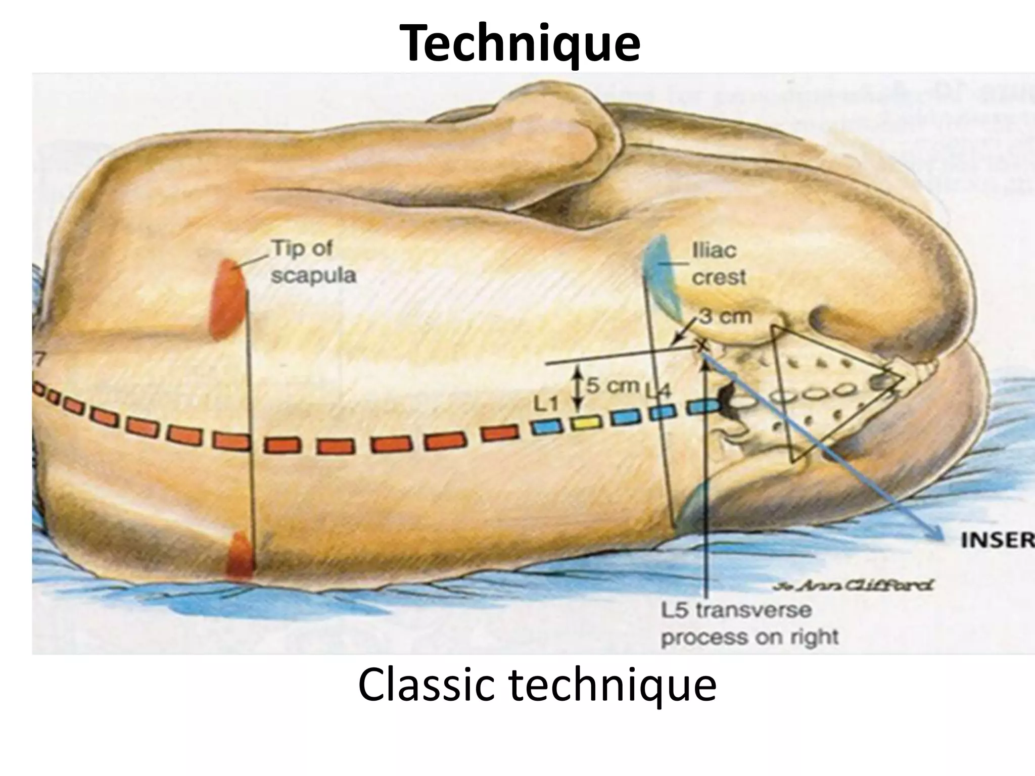 PNB of lower limb & paravertebral block | PPTX