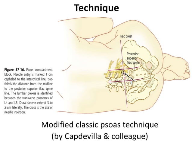 PNB of lower limb & paravertebral block | PPTX