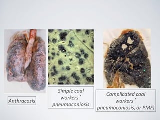 pnemoconiosis.pdf