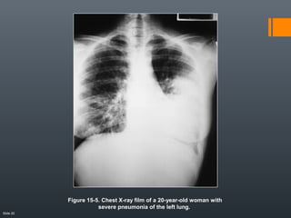 DIAGNOSIS OF PNEUMONIA Dr Vinay Verma | PPT