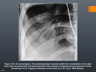 DIAGNOSIS OF PNEUMONIA Dr Vinay Verma | PPT