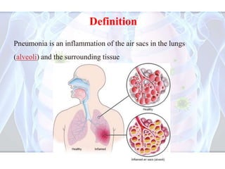 pneomonia.pptx | Infectious Diseases | Diseases and Conditions