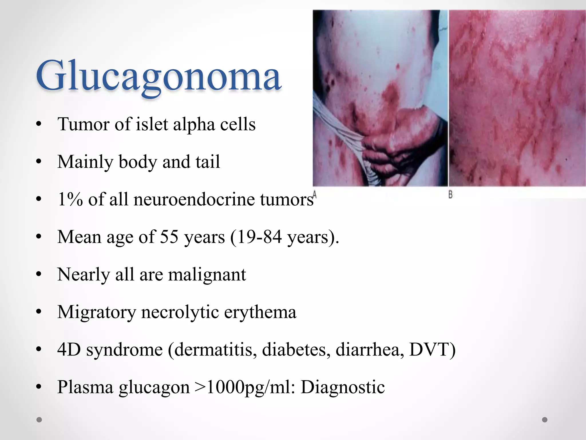 Pancreatic neuroendocrine tumors | PPTX