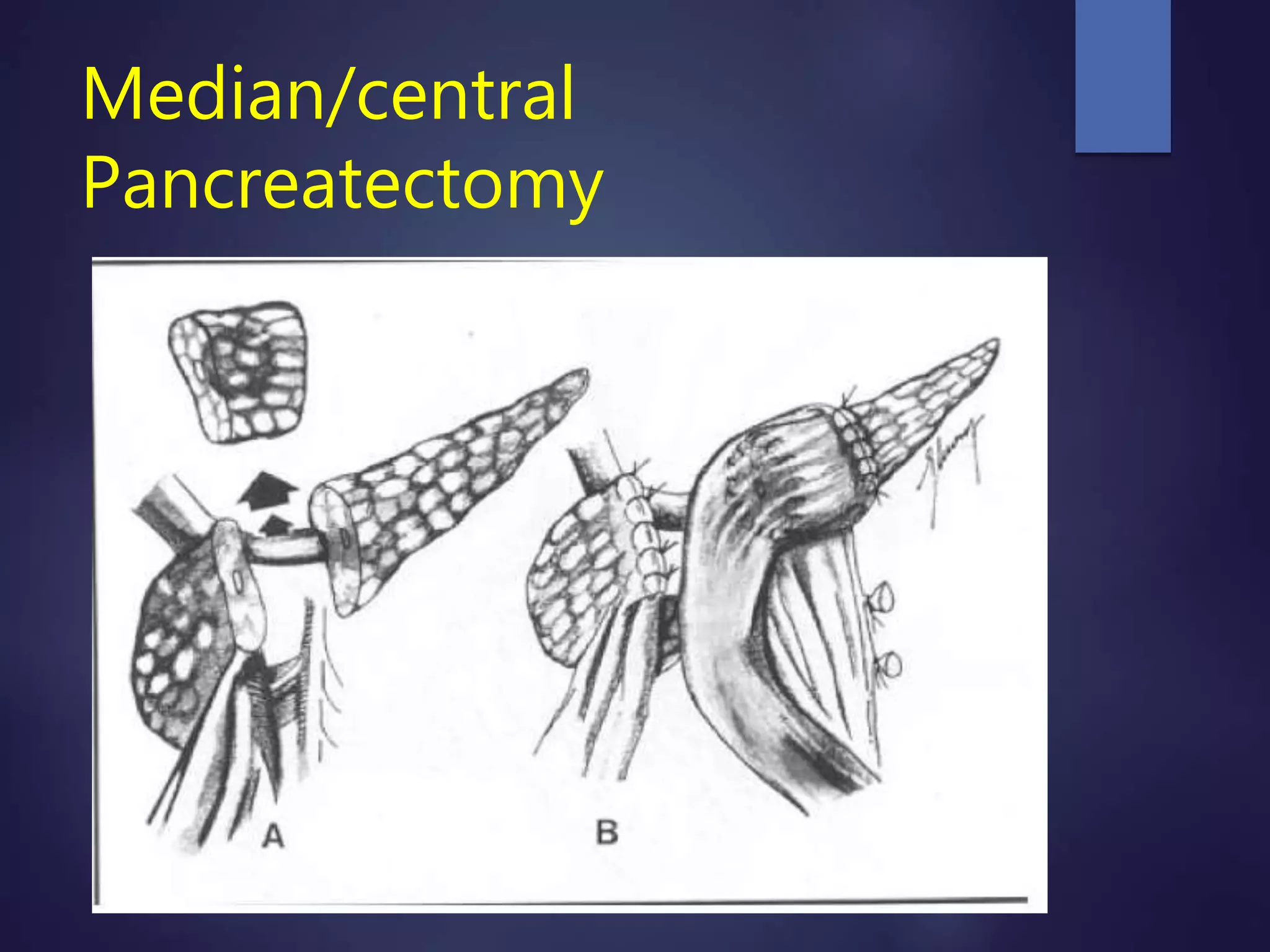 Pancreatic Neuroendocrine Tumors | PPTX