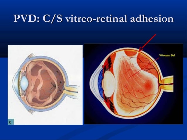 NW2011 Pneumatic retinopexy