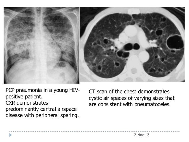 Pneumonia