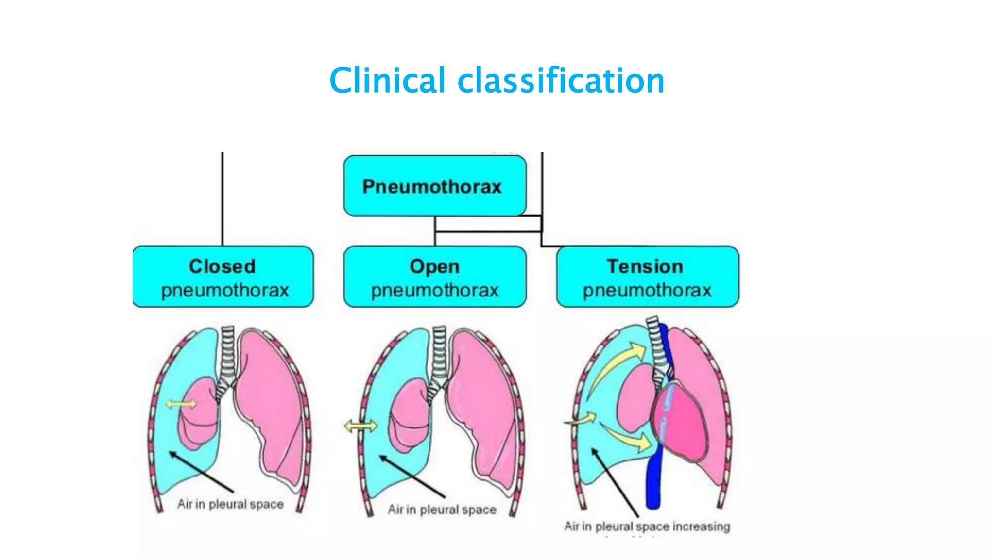 Pneumothorax | PPTX