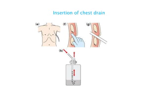 Pneumothorax | PPTX