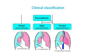 Pneumothorax | PPTX