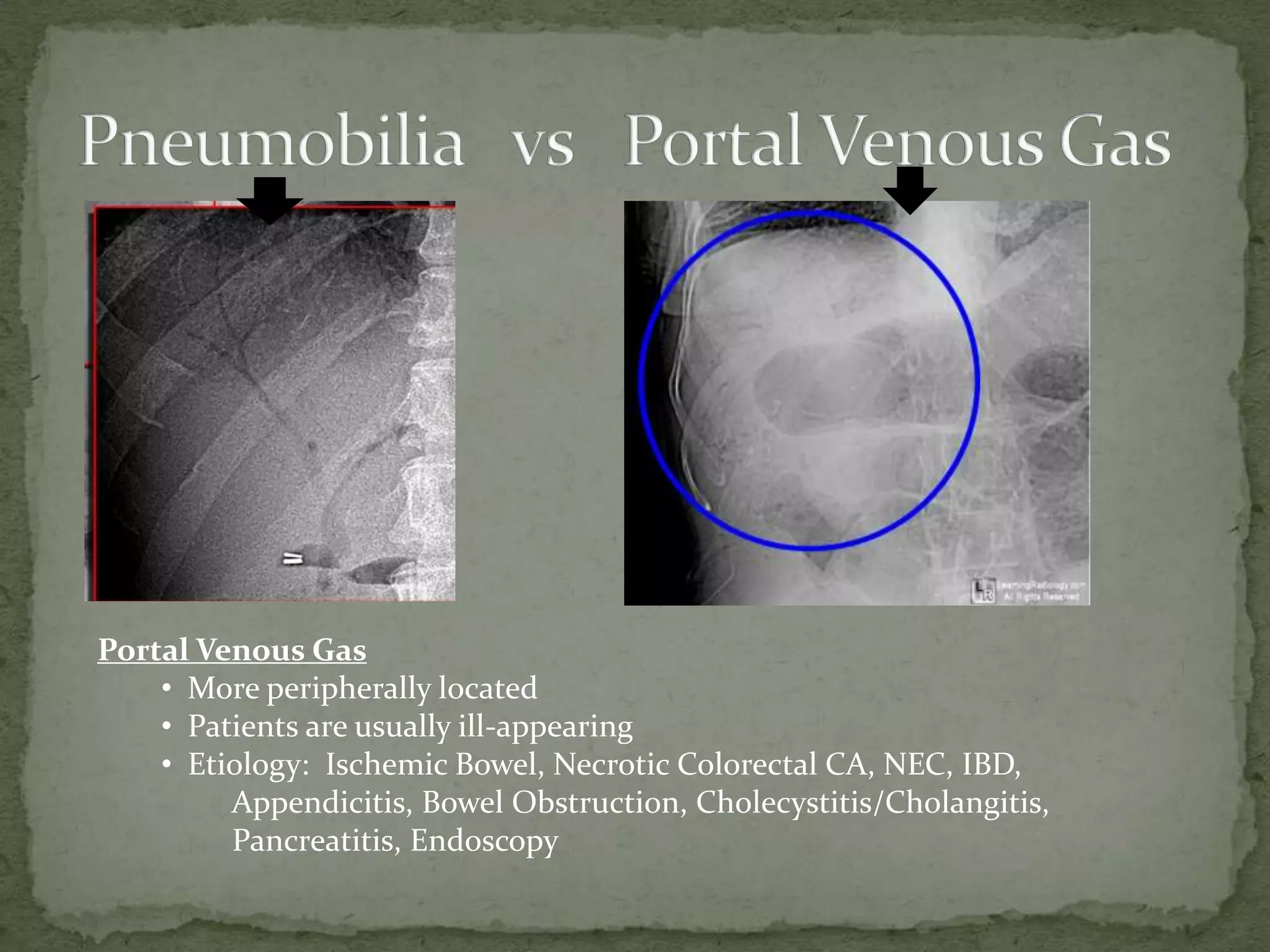 Pneumobilia Power Point | PPTX