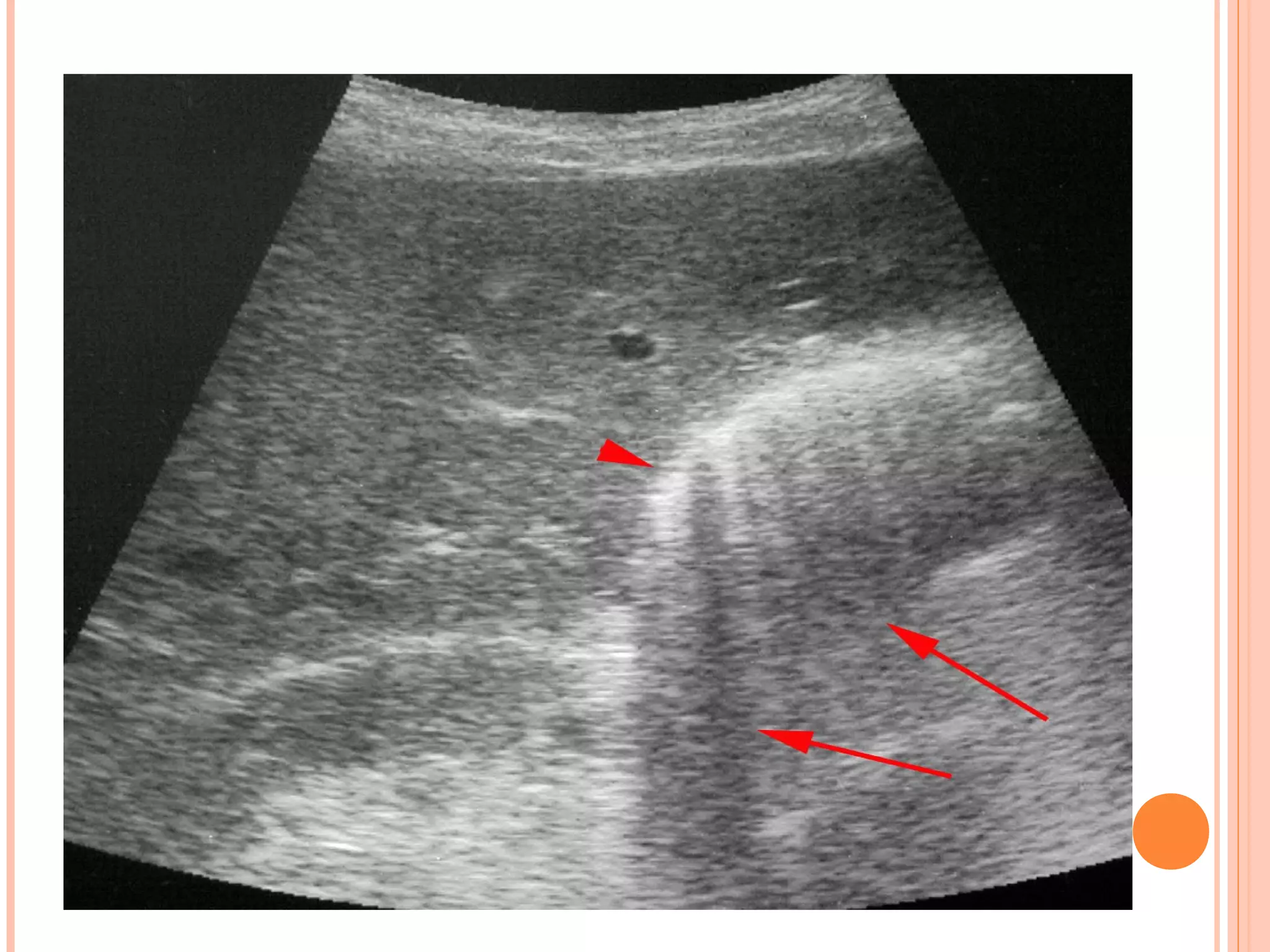 Pneumobilia vs portal vein gas | PPT